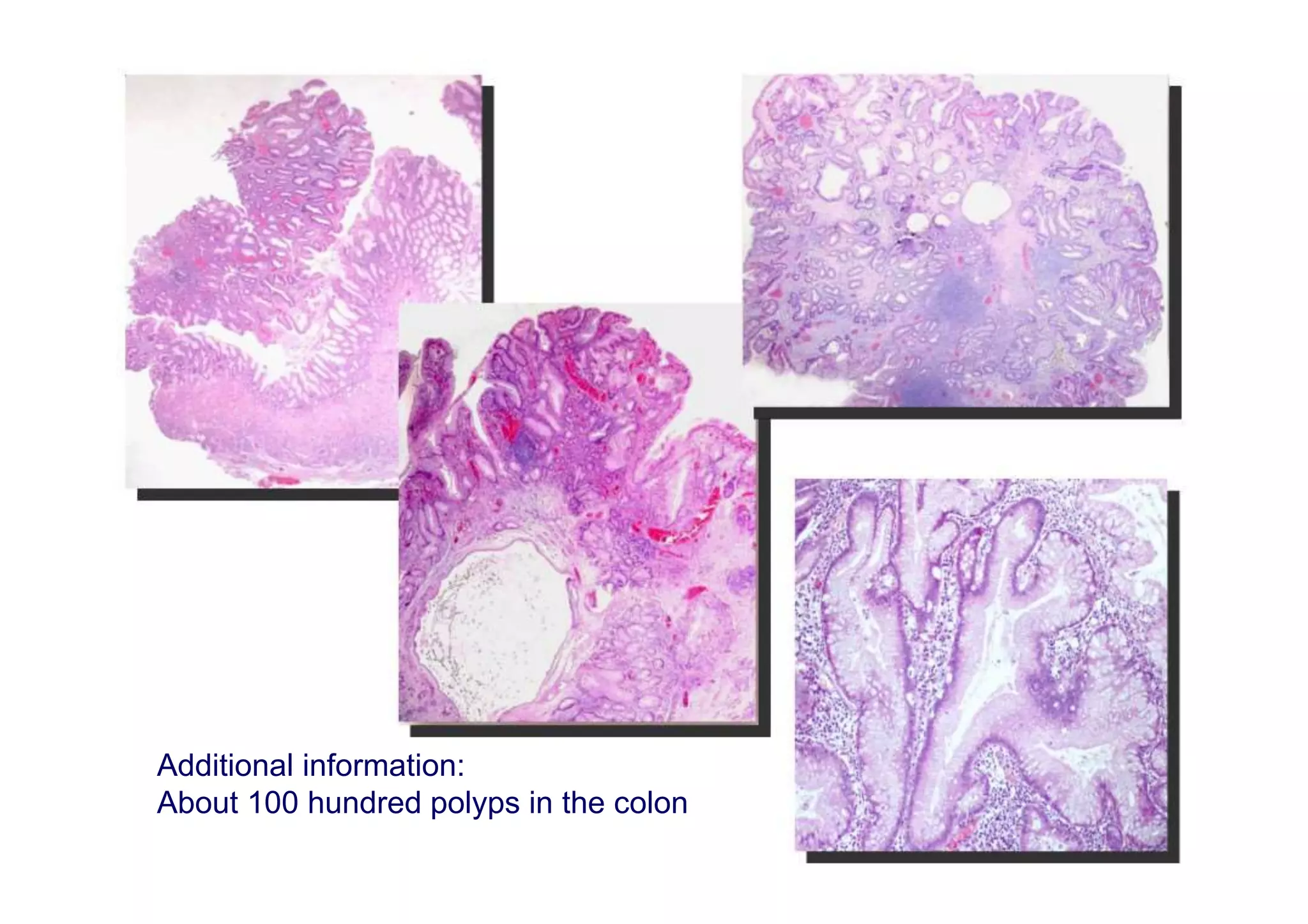 Gastric polyps | PPTX