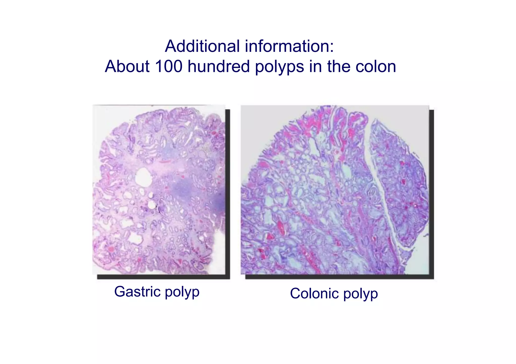 Gastric polyps | PPTX