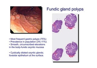 Gastric polyps | PPTX