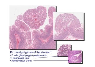 Gastric polyps | PPTX