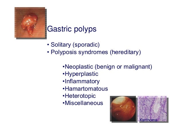 Gastric polyps