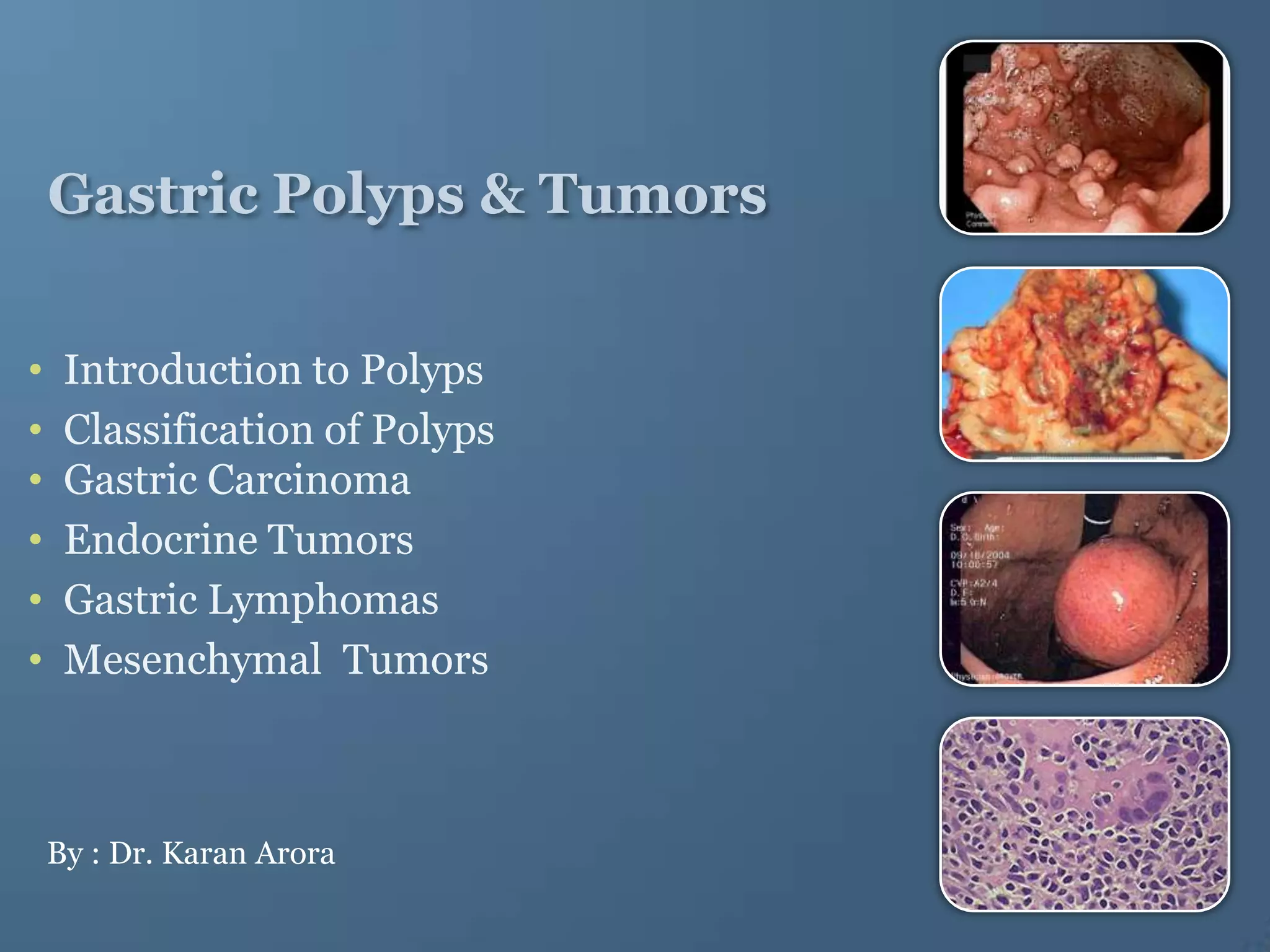 Gastric polyps & tumors by Dr. Karan Arora | PPTX