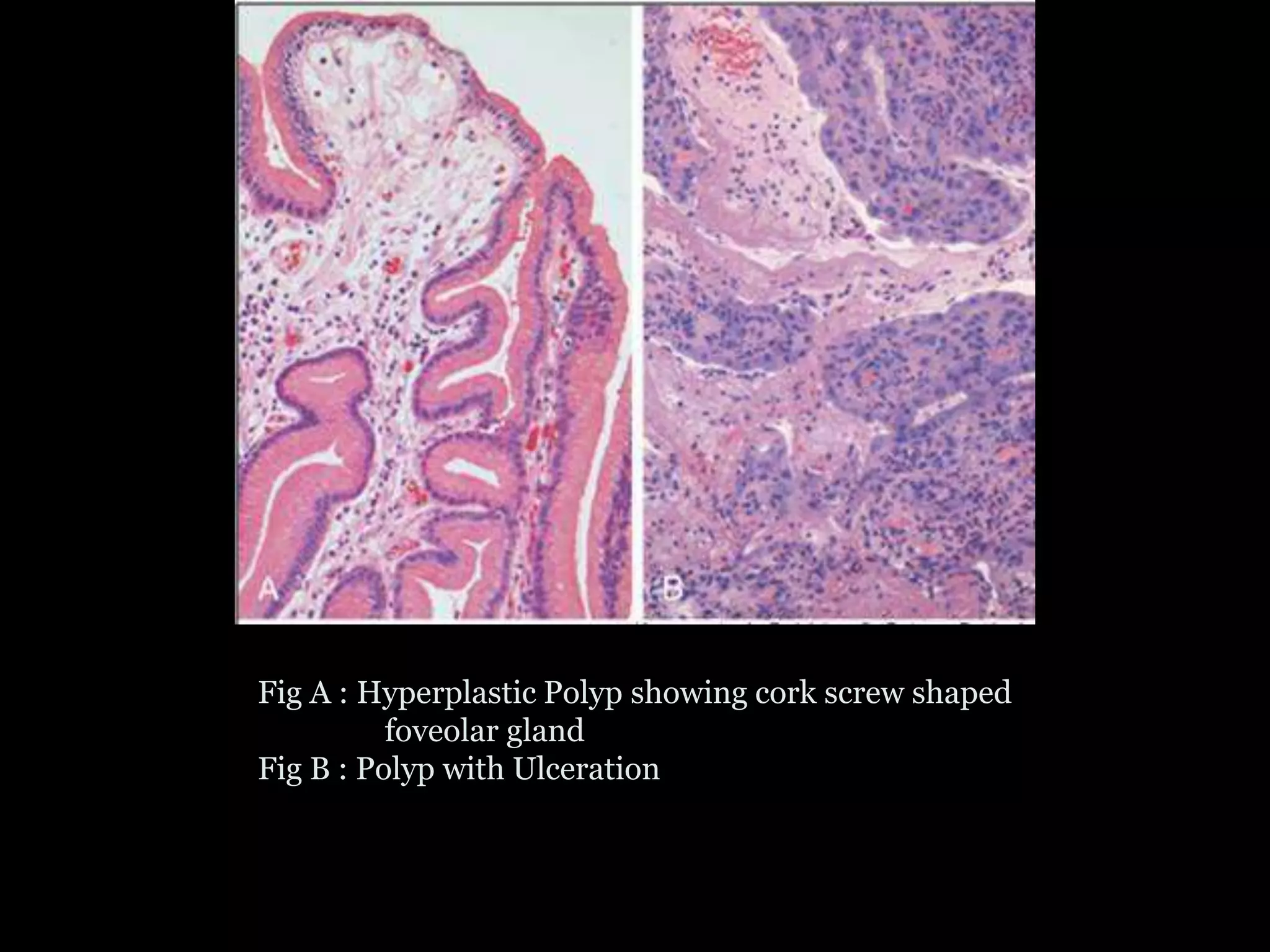 Gastric polyps & tumors by Dr. Karan Arora | PPTX