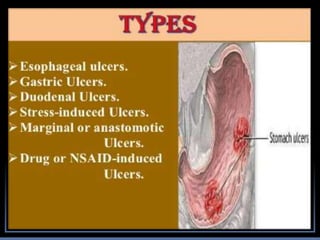 Gastric proton pump inhibitor | PPTX