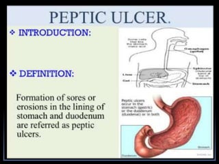 Gastric proton pump inhibitor | PPT
