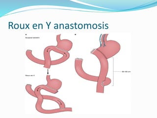 GASTRIC SURGERY AND ITS COMPLICATIONS.pptx | Digestive Disorders | Diseases and Conditions