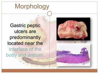 gastriculcer-130106093745-phpapp01.pptx