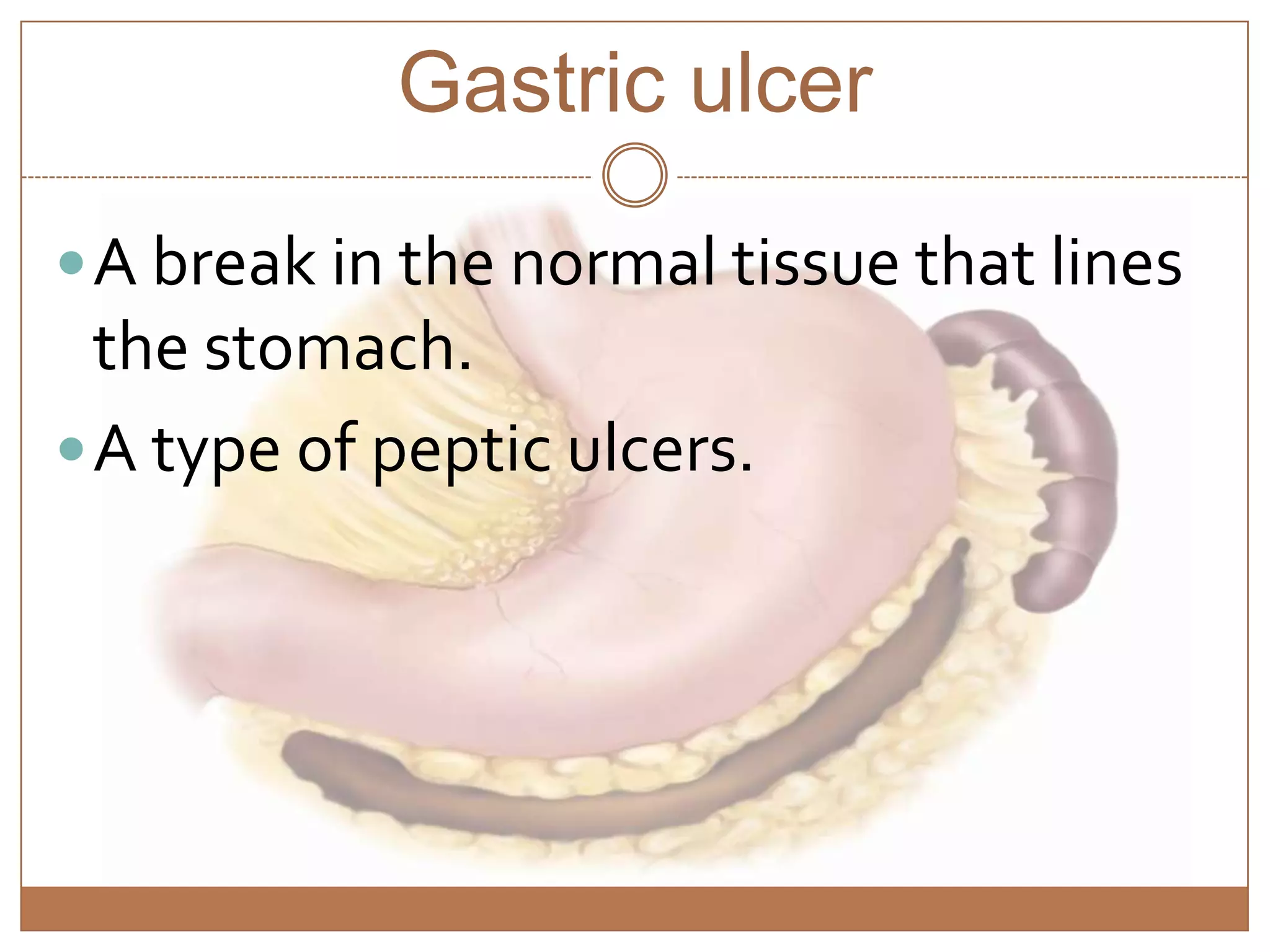 Gastric Ulcer | PPTX | Digestive Disorders | Diseases and Conditions