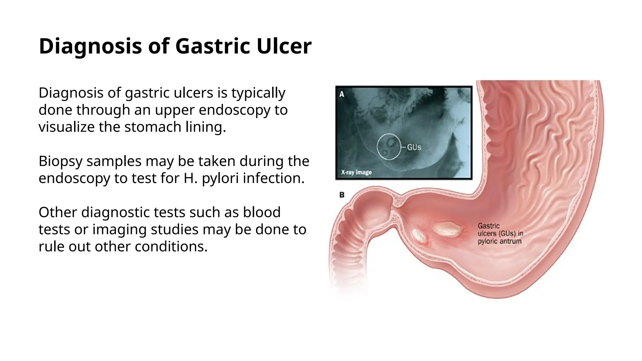 Gastric Ulcer and their treatment .pptx