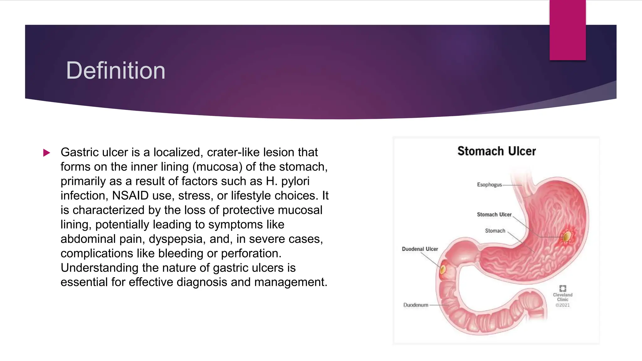 Gastric Ulcer by Wakib Amin.pptx