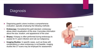 Gastric Ulcer by Wakib Amin.pptx