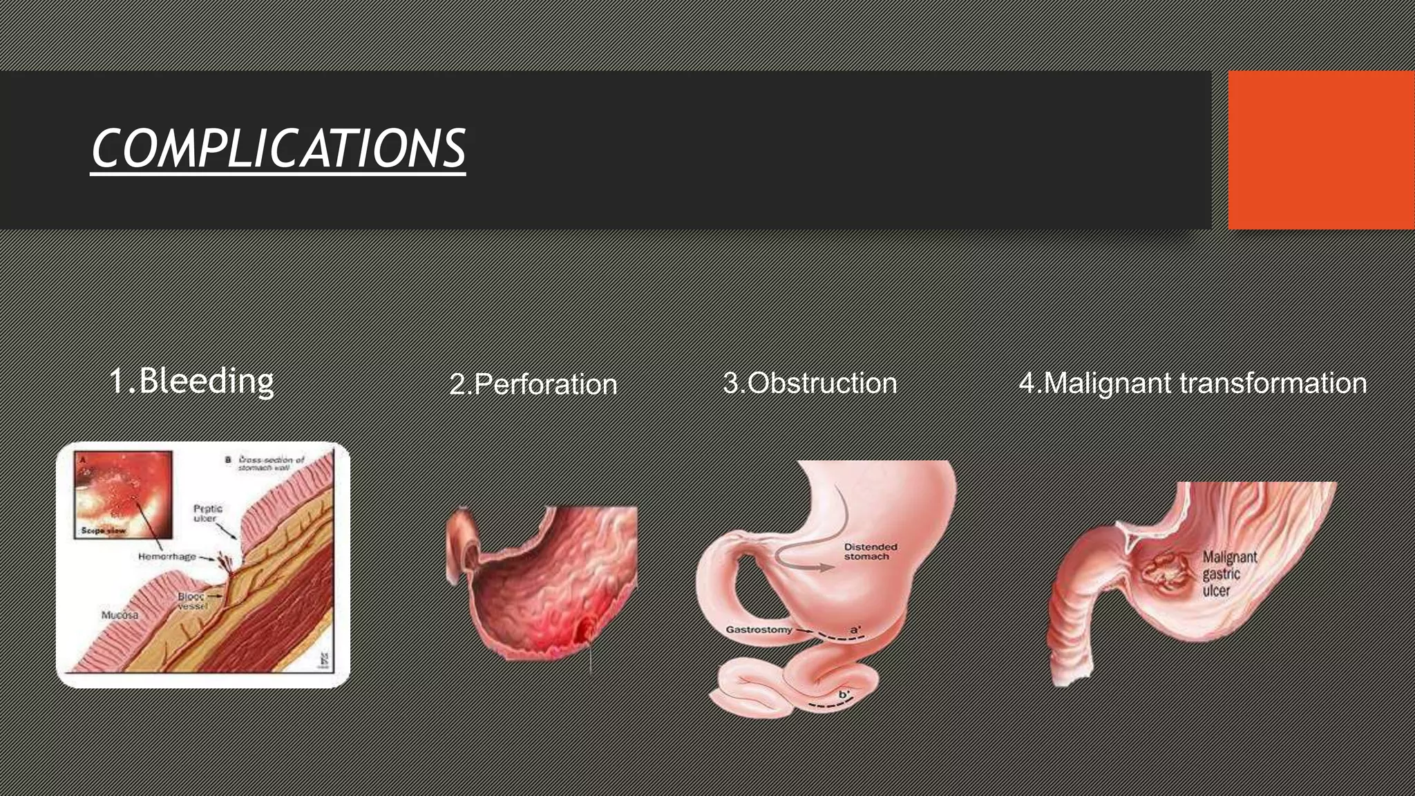 Gross and Histopathological findings & complications of GASTRIC ULCERS ...