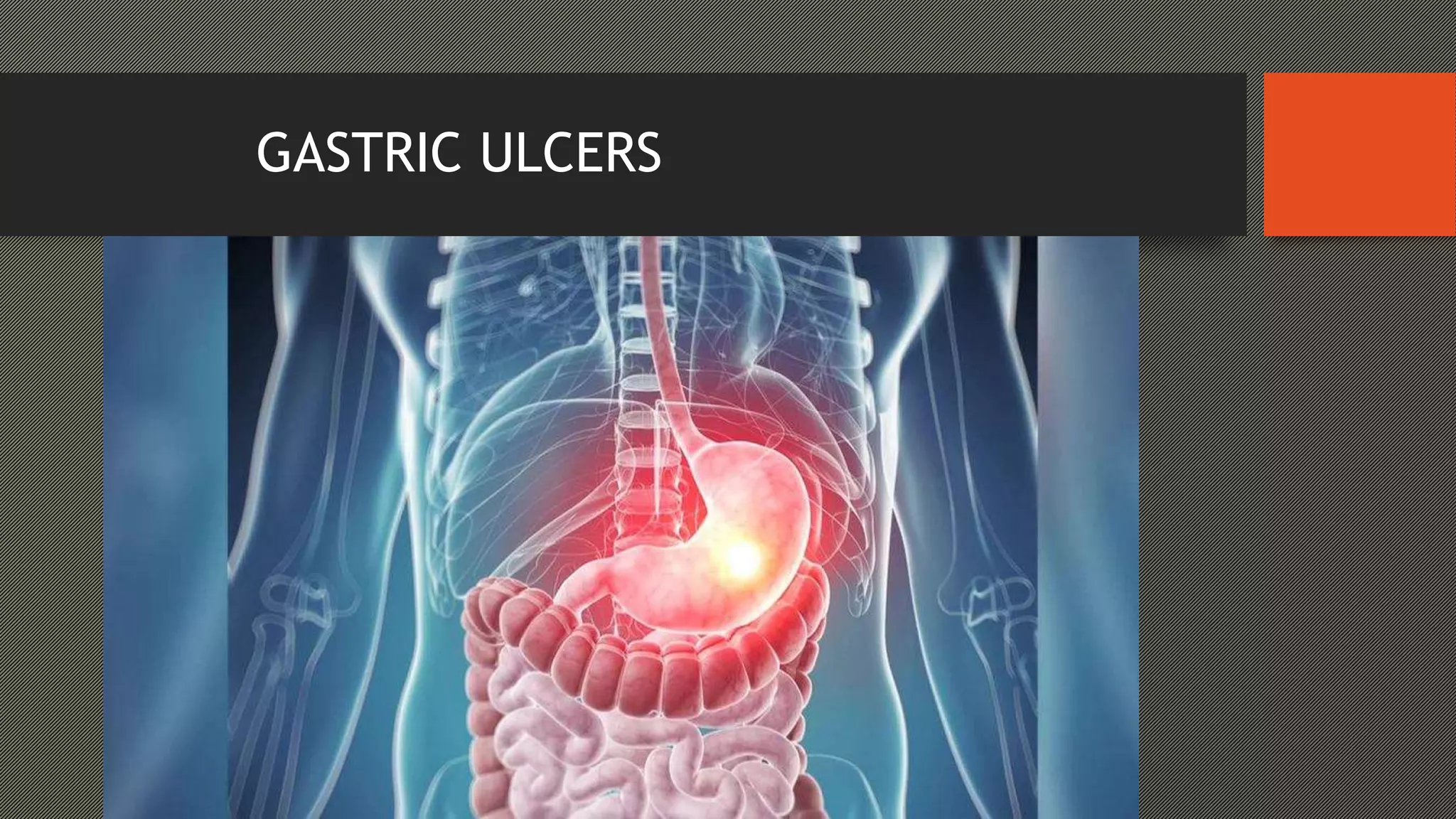 Gross and Histopathological findings & complications of GASTRIC ULCERS ...
