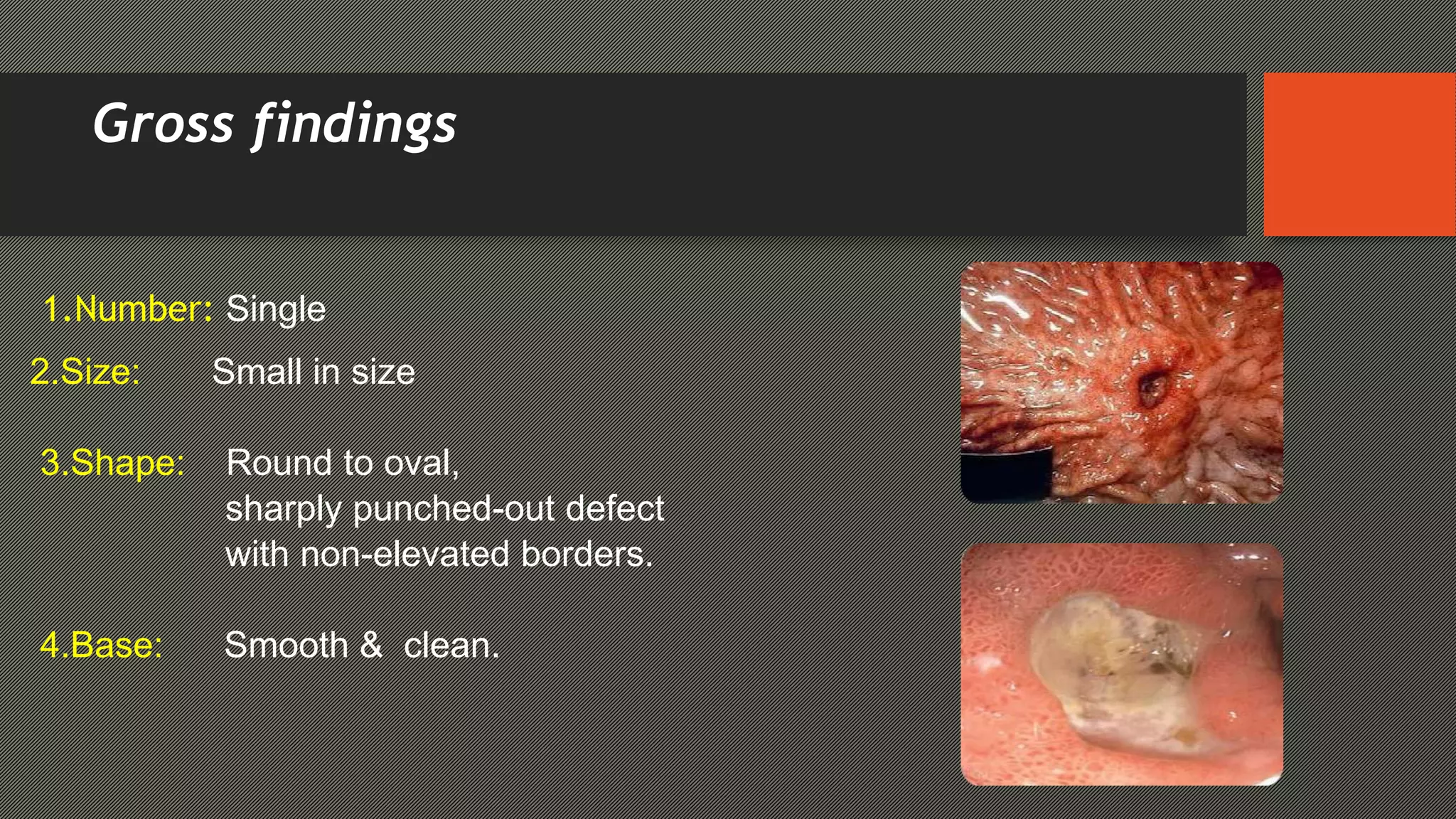 Gross and Histopathological findings & complications of GASTRIC ULCERS ...