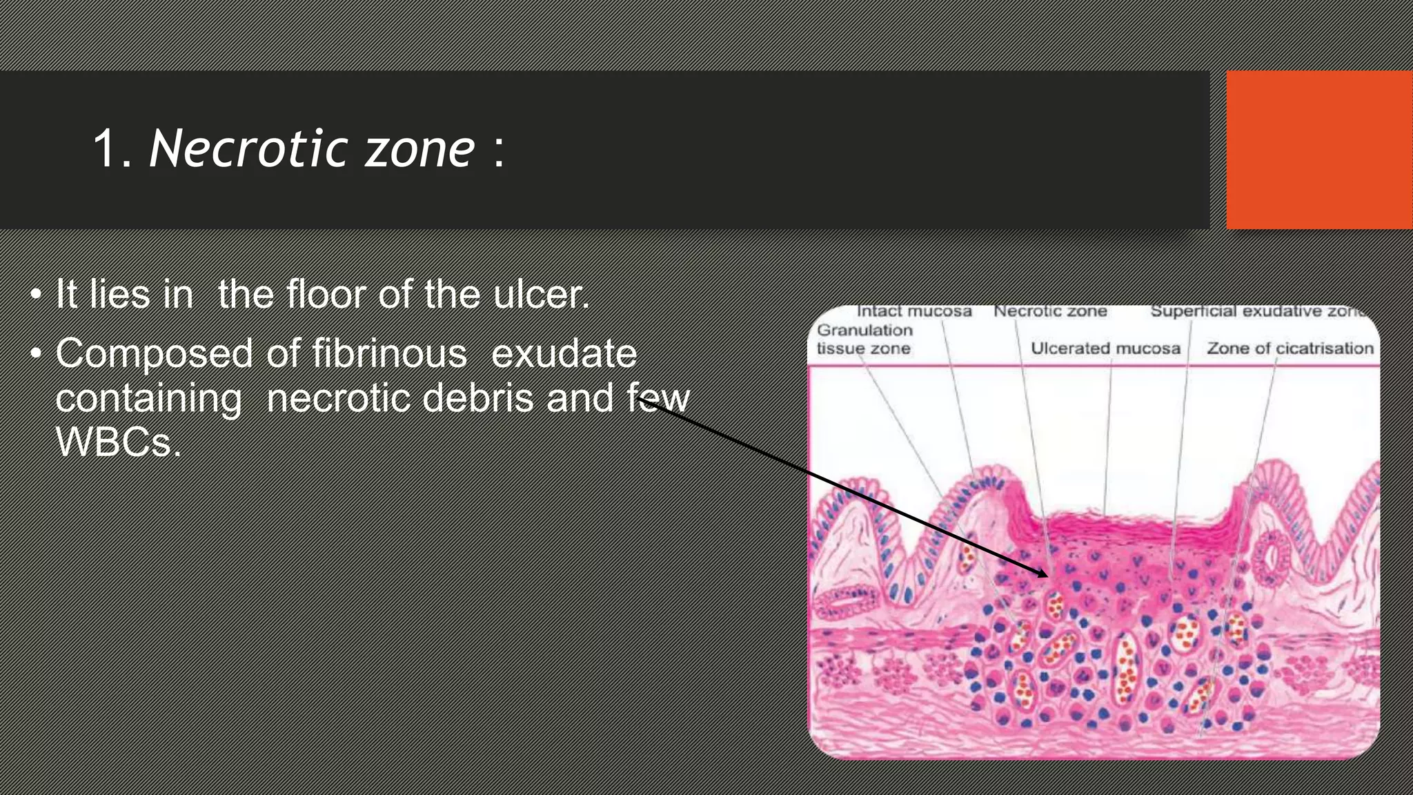 Gross and Histopathological findings & complications of GASTRIC ULCERS ...