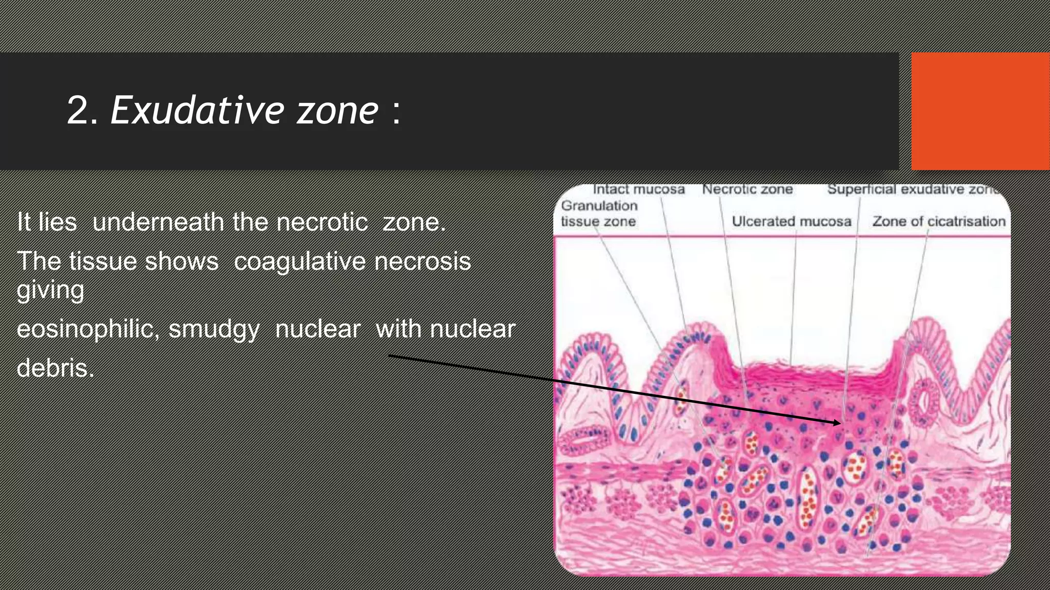Gross and Histopathological findings & complications of GASTRIC ULCERS ...