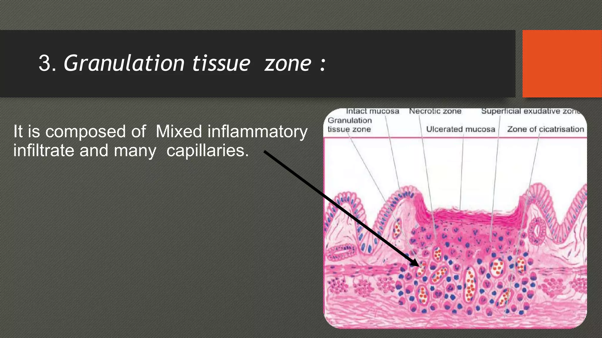 Gross and Histopathological findings & complications of GASTRIC ULCERS ...