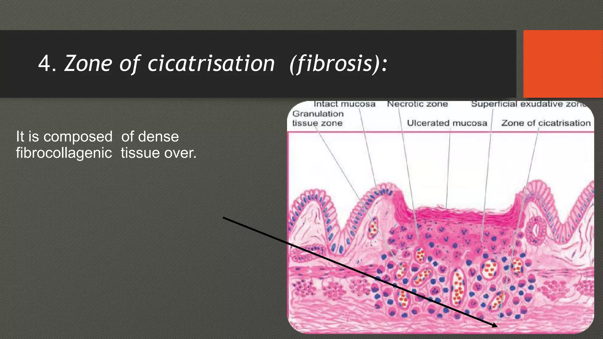 Gross and Histopathological findings & complications of GASTRIC ULCERS ...