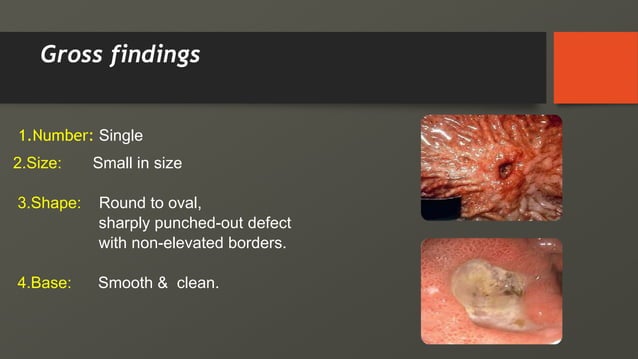 Gross and Histopathological findings & complications of GASTRIC ULCERS ...