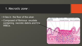 Gross and Histopathological findings & complications of GASTRIC ULCERS ...