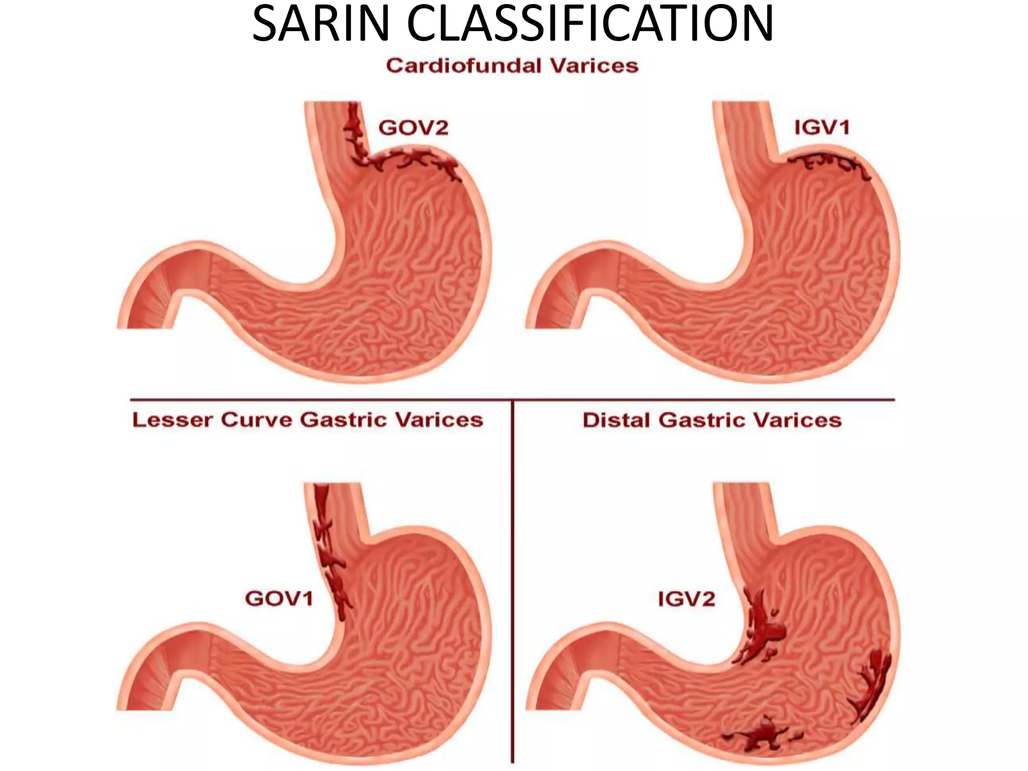 gastric varices.pptx