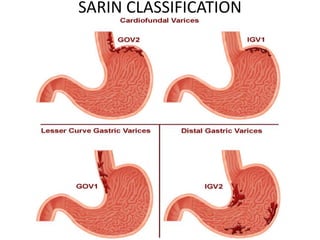 gastric varices.pptx