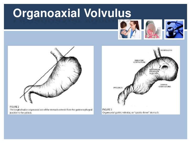 Gastric volvulus