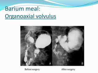 Gastric volvulus and other types of volvulus | PPTX