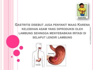 Gastritis | PPTX