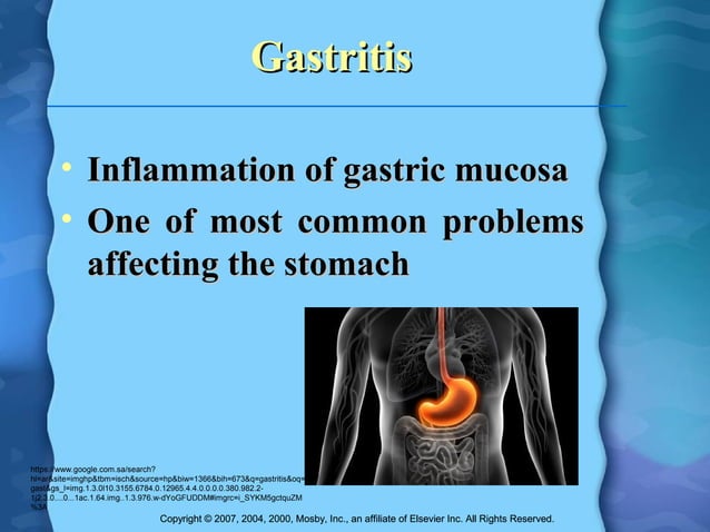 Gastritis | PPT