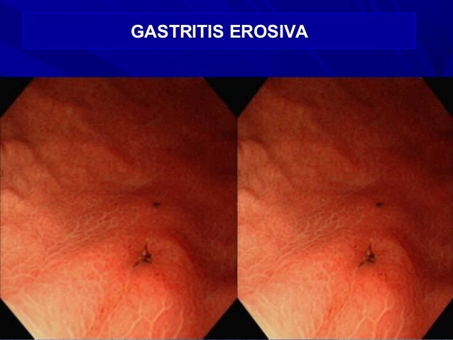 Gastritis mas endoscopias, (gastroenterologia medica)