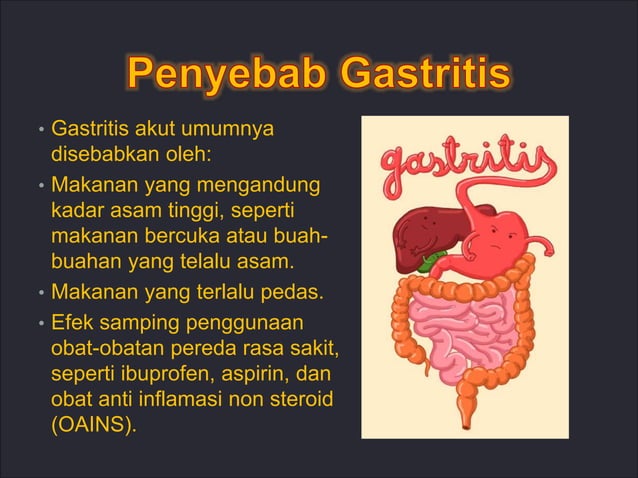 Gastritis | PPTX