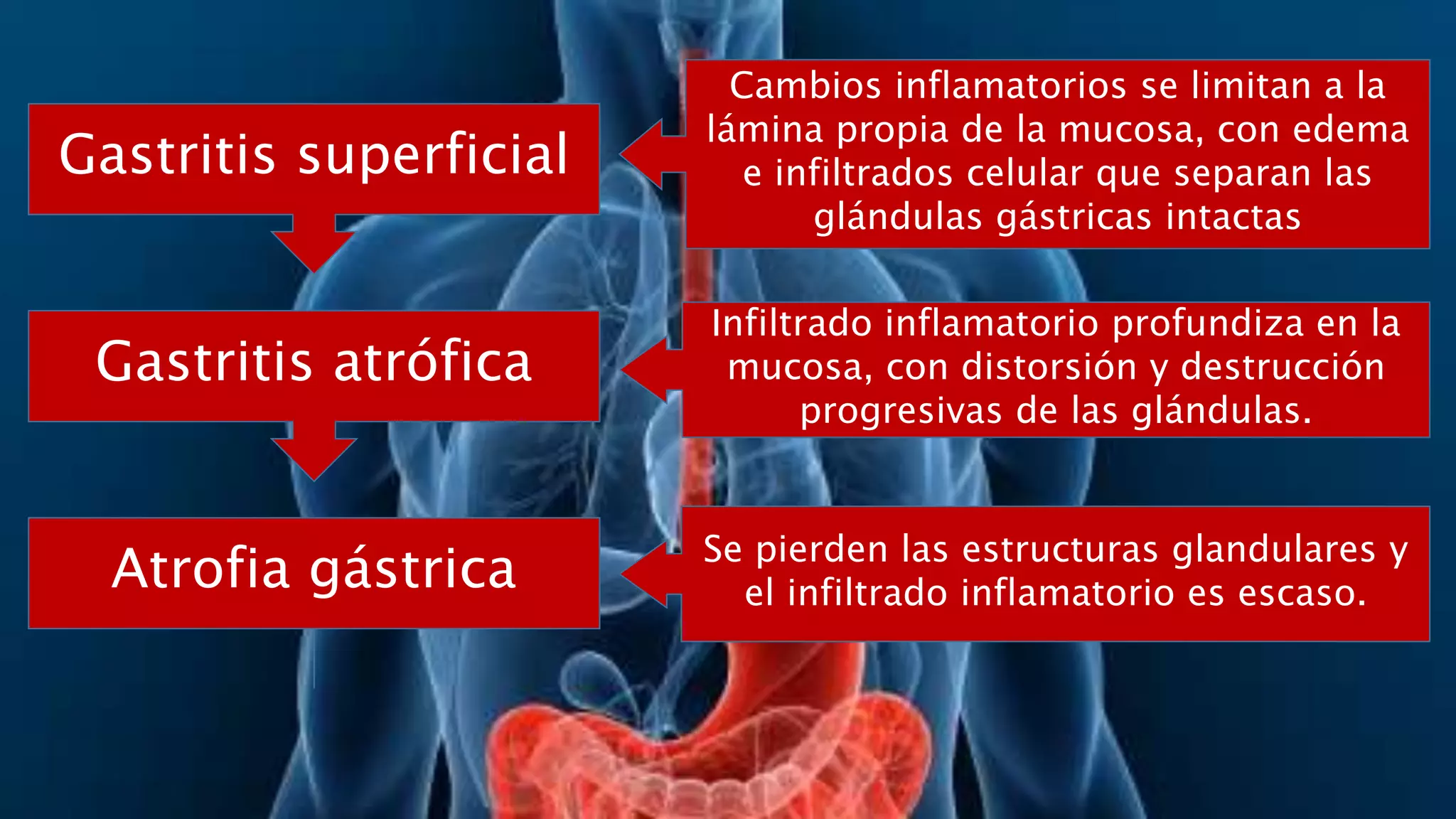Gastritis | PPT