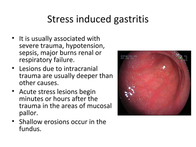 Gastritis | PPT | Digestive Disorders | Diseases and Conditions