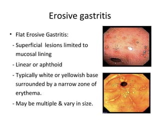 Gastritis | PPT