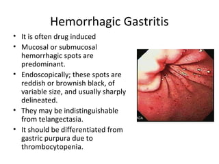 Hemorrhagic Gastritis