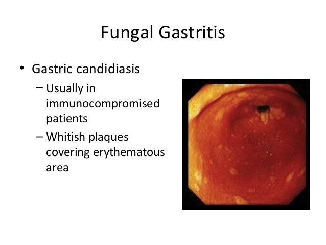 Gastritis