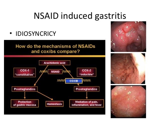 Gastritis
