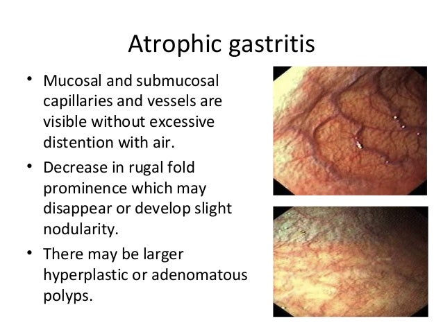 Gastritis