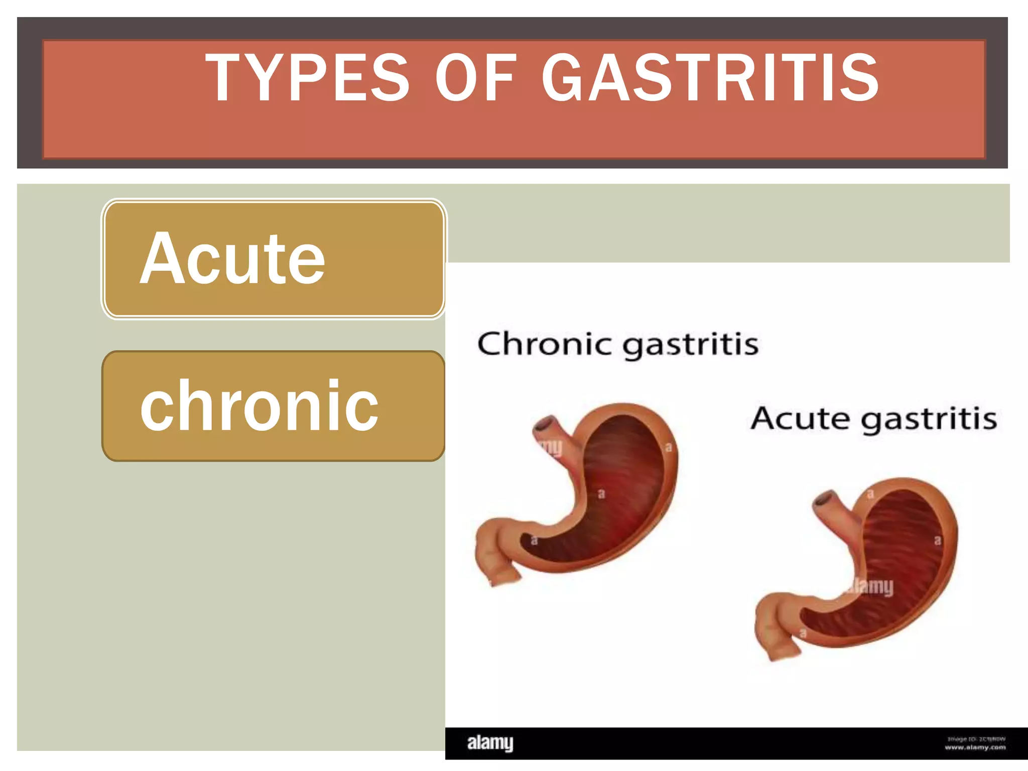 Gastritis | PPTX