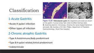 Gastritis.pptx
