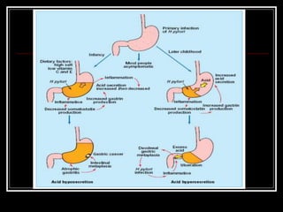 GASTRITIS.ppt