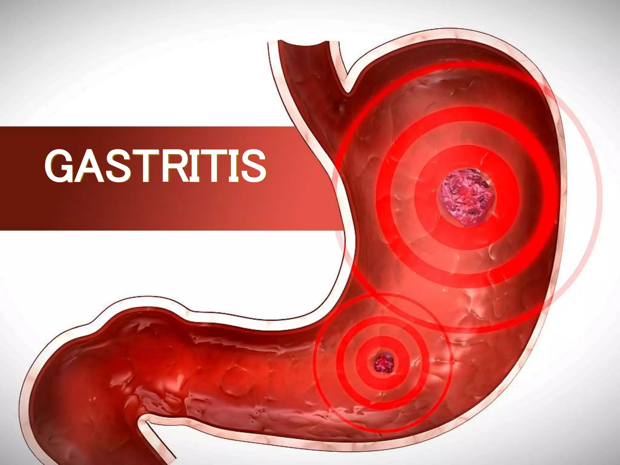 GASTRITIS.pptx