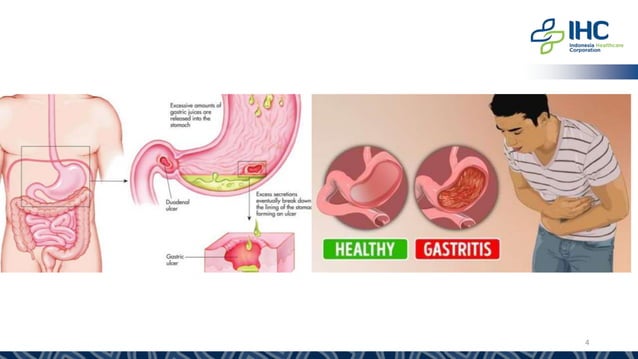 gastritis.pptx