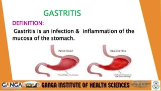 GASTRITIS.pptx