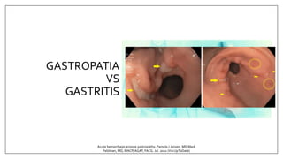 Gastritis | PPTX