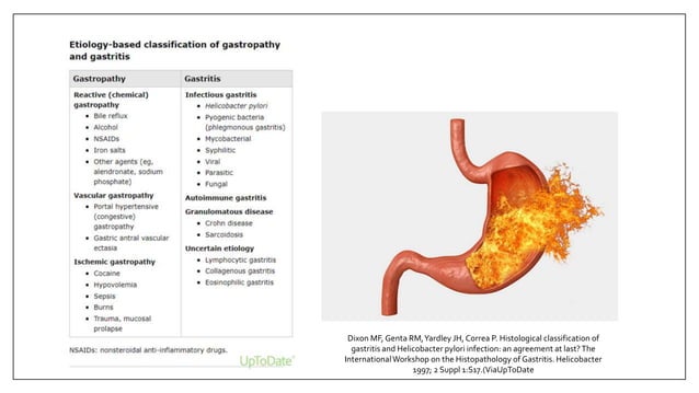 Gastritis | PPT | Free Download