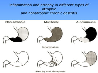 Gastritis.ppt.pdf