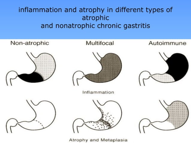 Gastritis.ppt.pdf