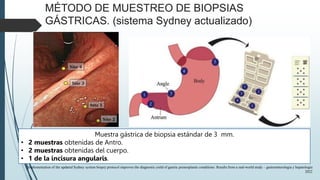 GASTRITIS.pptx